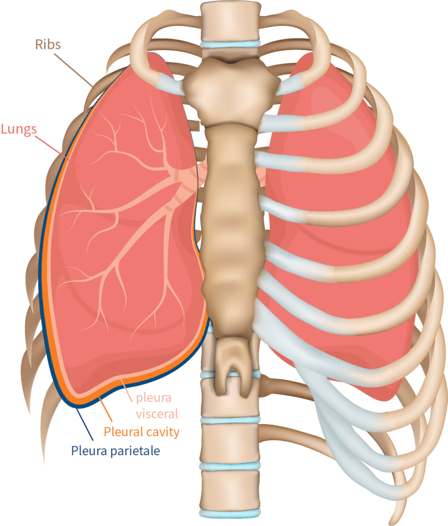 Pleural effusion or water in the lungs? Inform here | ewimed