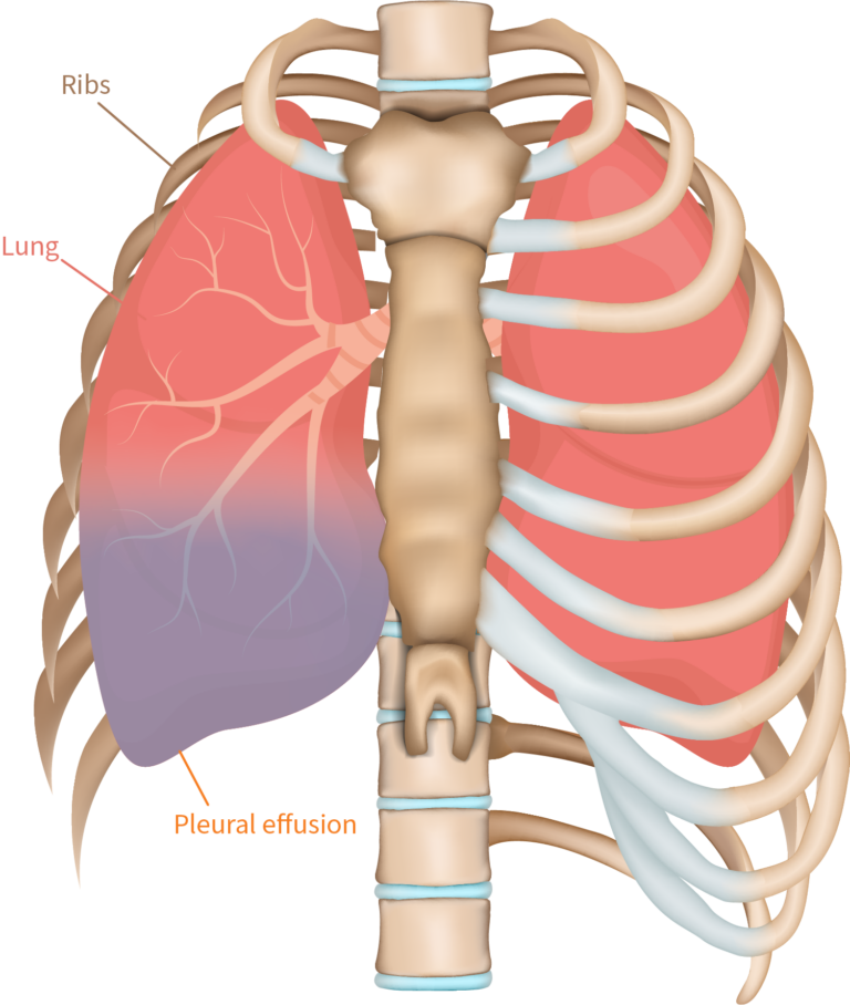 Pleural effusion or water in the lungs? Inform here | ewimed
